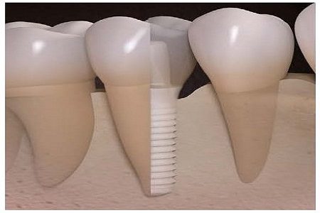 Ceramic Implants in Pasadena: Metal-Free and Aesthetic