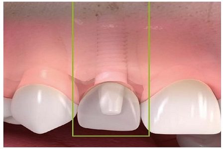 Implant / Bone Grafting - Bone Augmentation - Art of Smiles